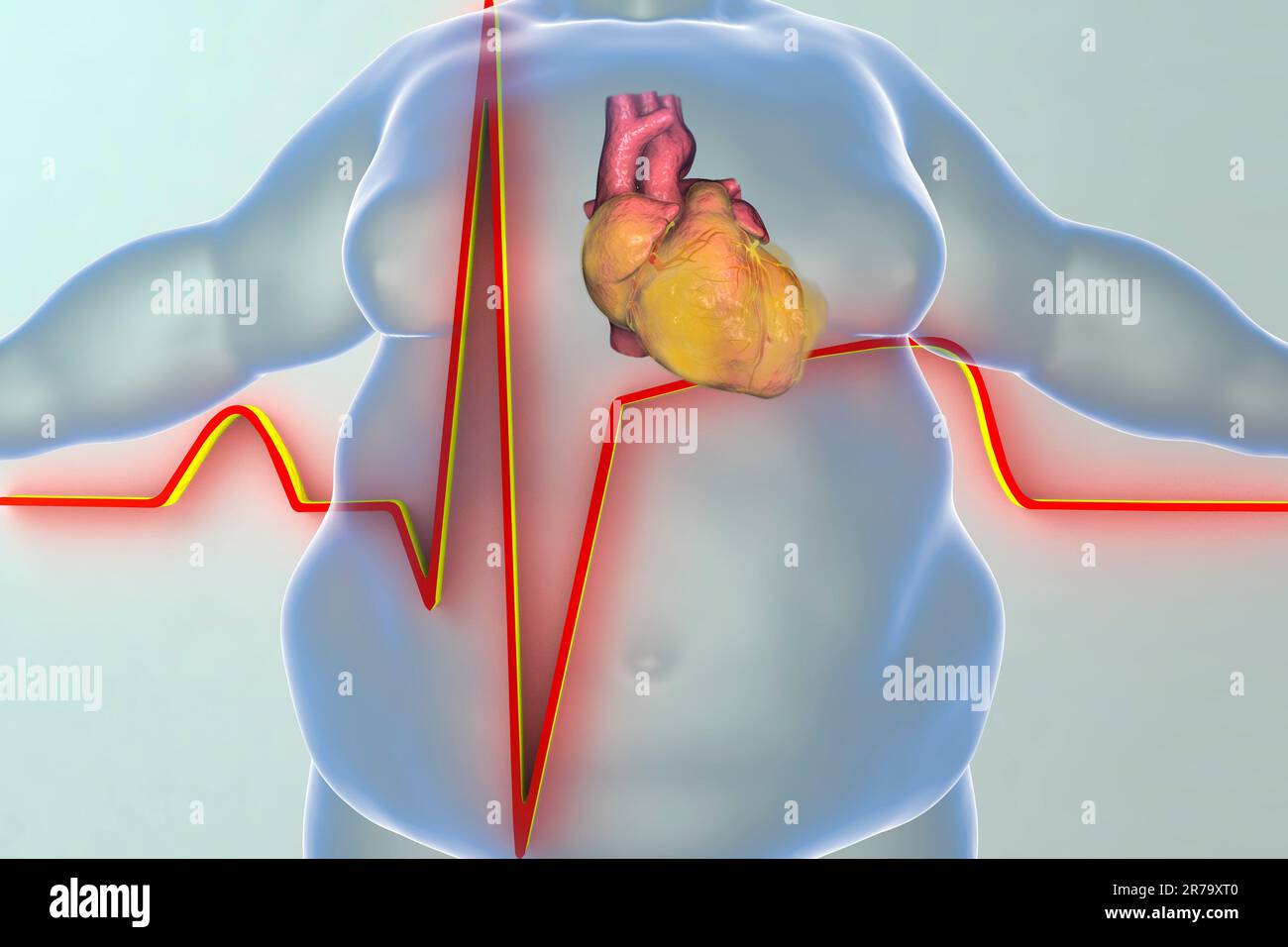 Heart disease in a person with obesity, conceptual image. 3D ...