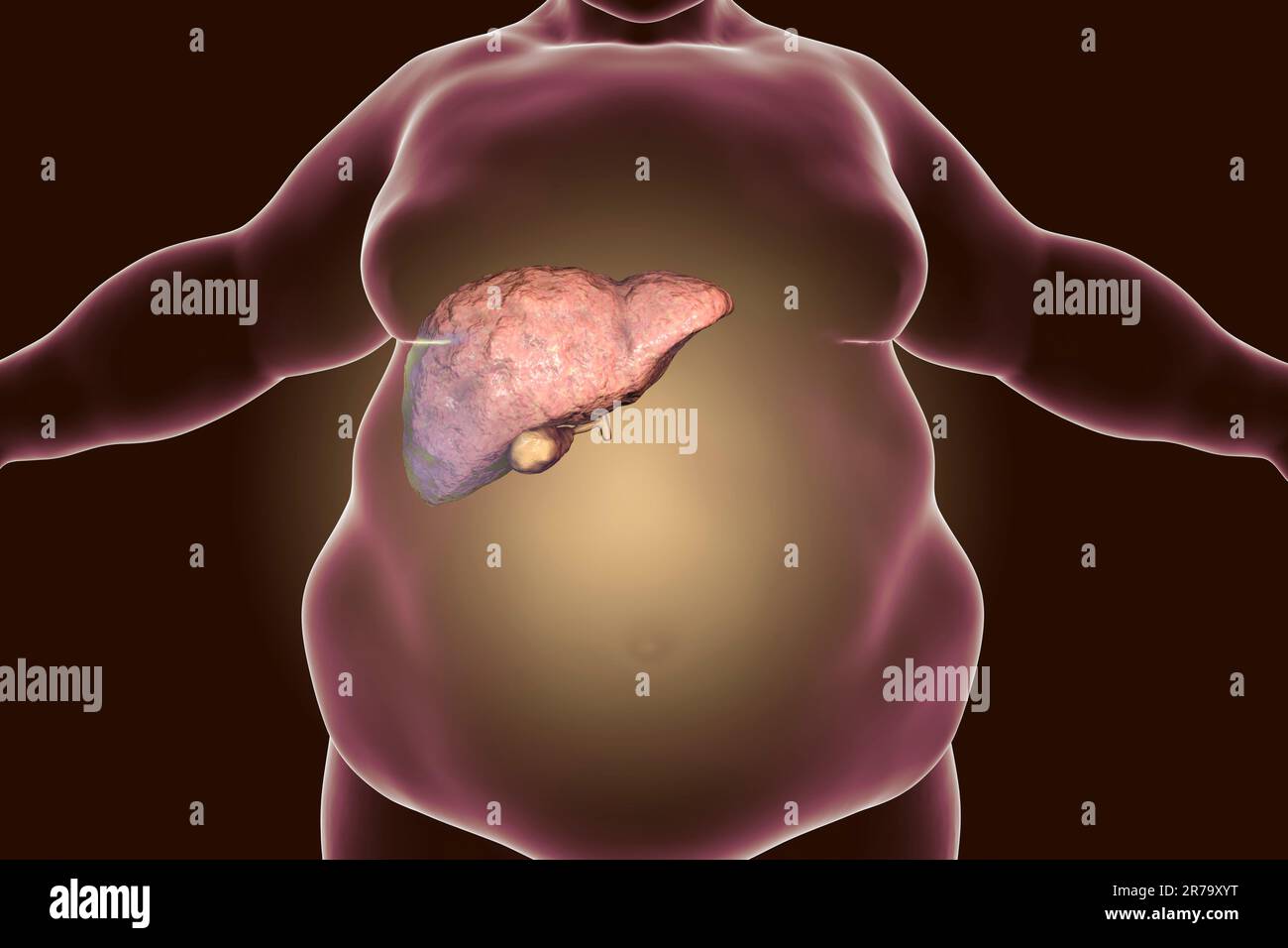 Obese man with fatty liver, 3D illustration. Conceptual image for non ...