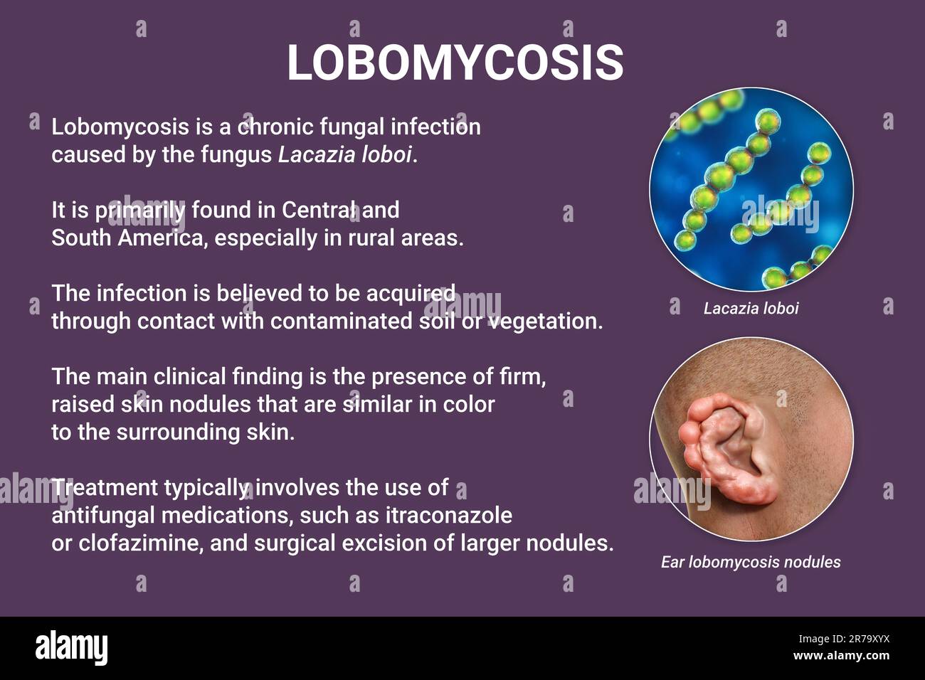 Lobomycosis, a chronic skin disease caused by microscopic fungi Lacazia ...