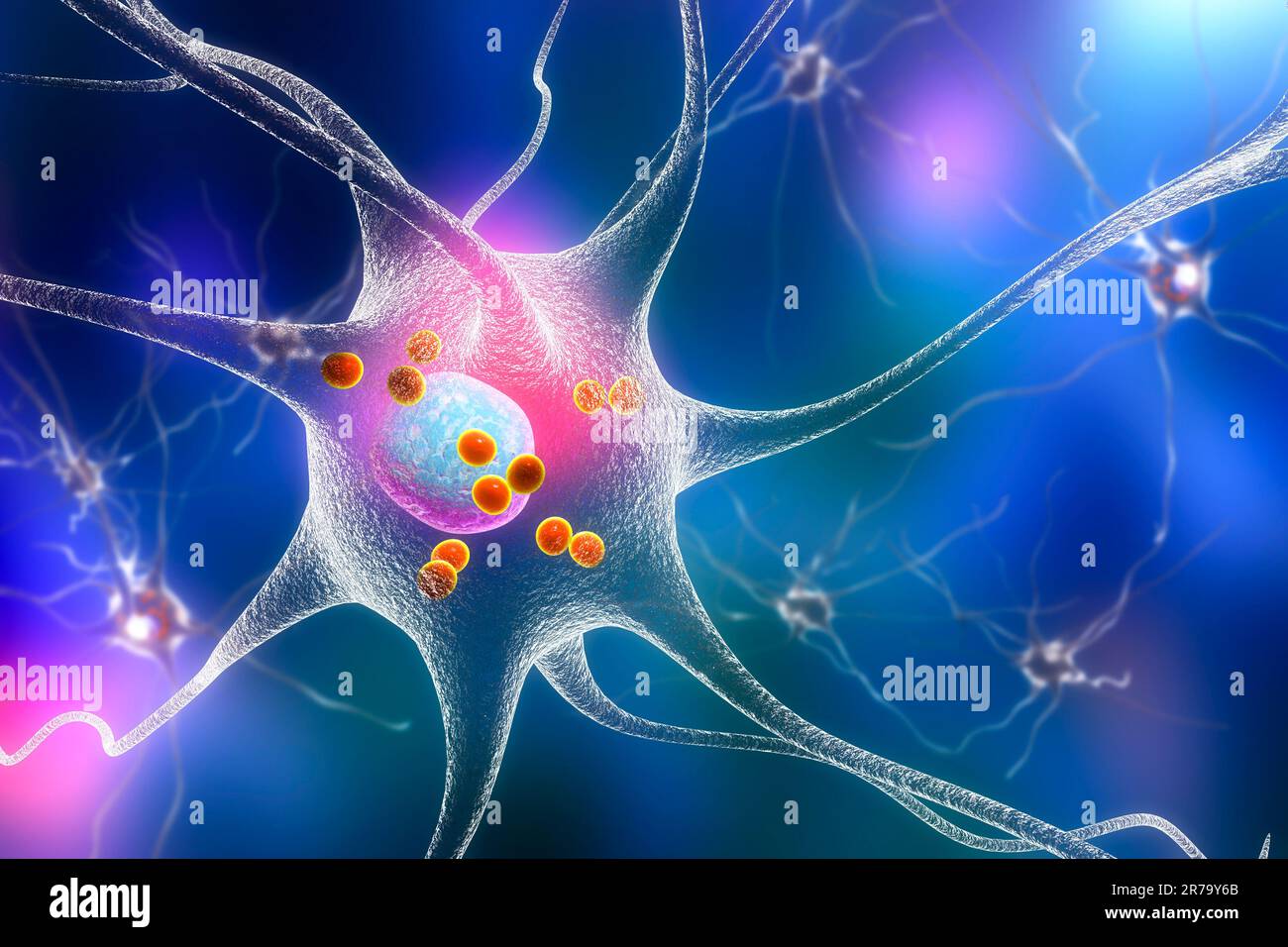 Parkinson's disease. 3D illustration showing neurons containing Lewy ...