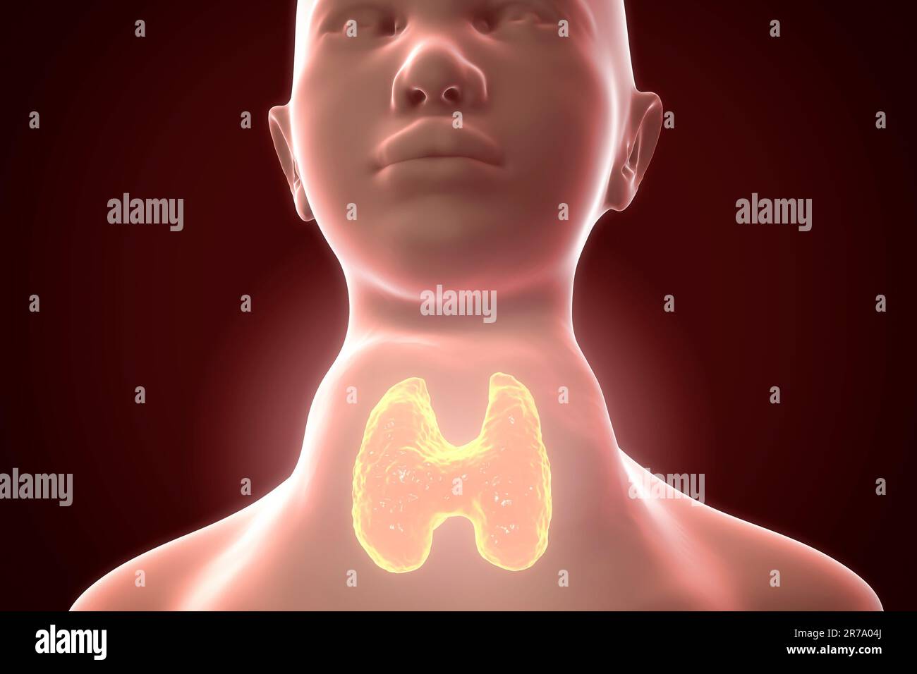 Toxic diffuse goiter, Flajani-Basedow-Graves' disease. 3D illustration ...