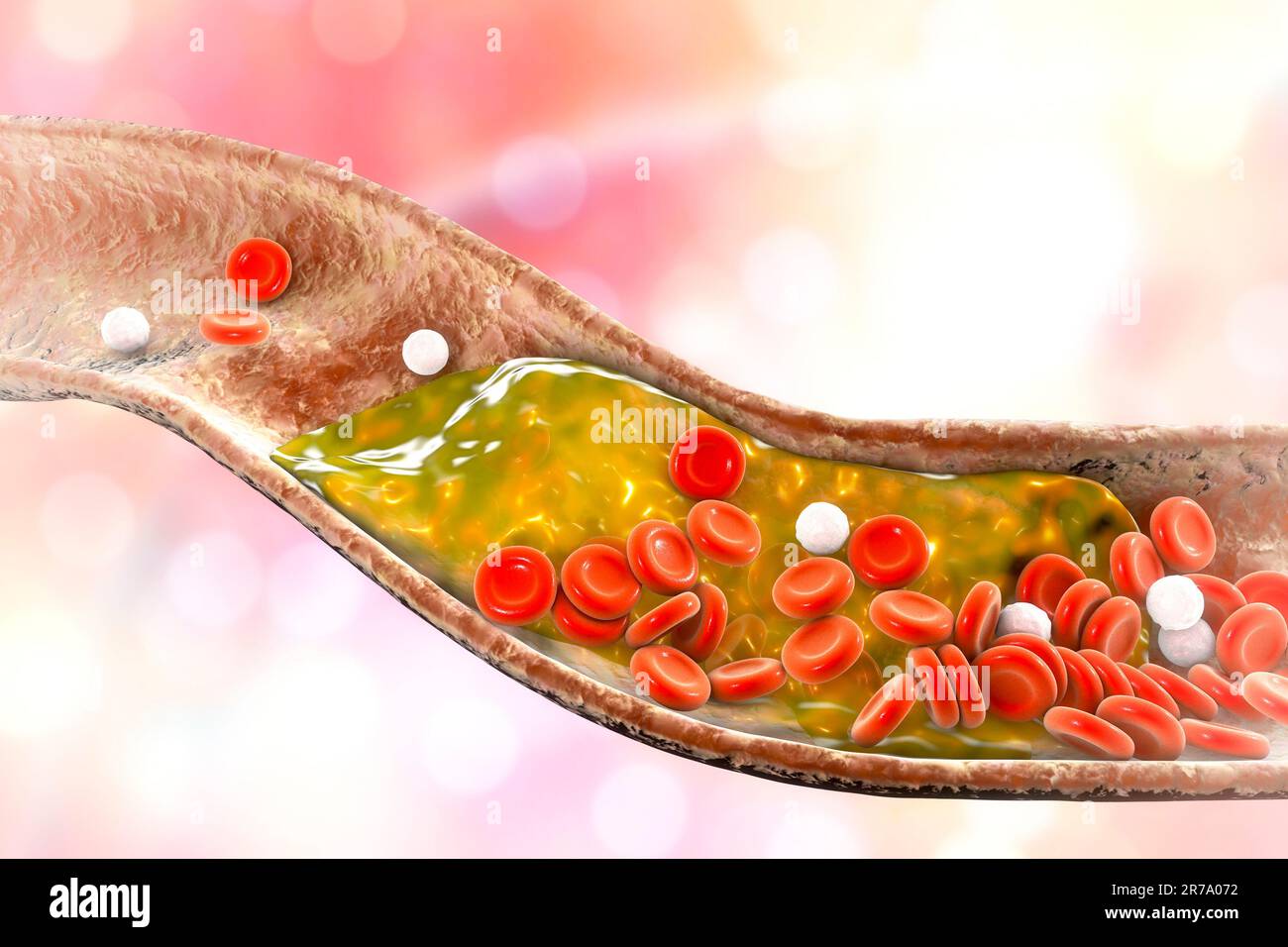 Cholesterol plaque in artery, 3D illustration. Concept for coronary ...