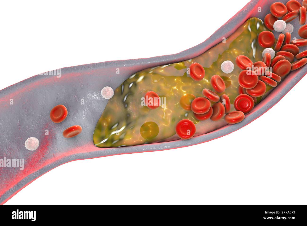 Cholesterol plaque in artery, 3D illustration. Concept for coronary ...