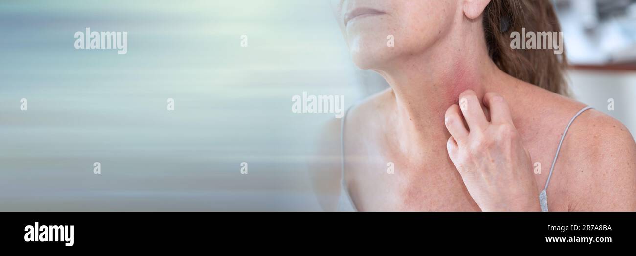 Woman having itchy and scratching her neck. allergy symptoms; panoramic banner Stock Photo - Alamy