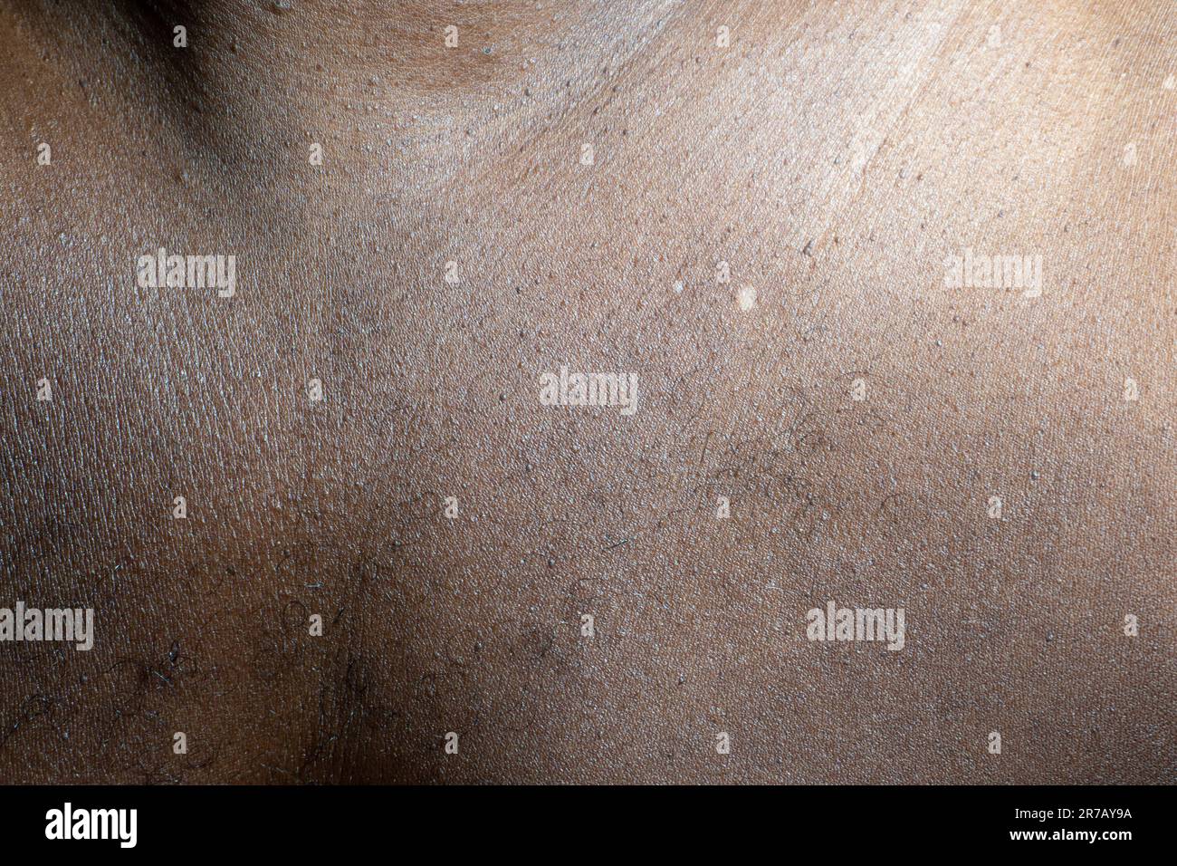 Photography of early stage of vitiligo on male upper chest area Stock ...