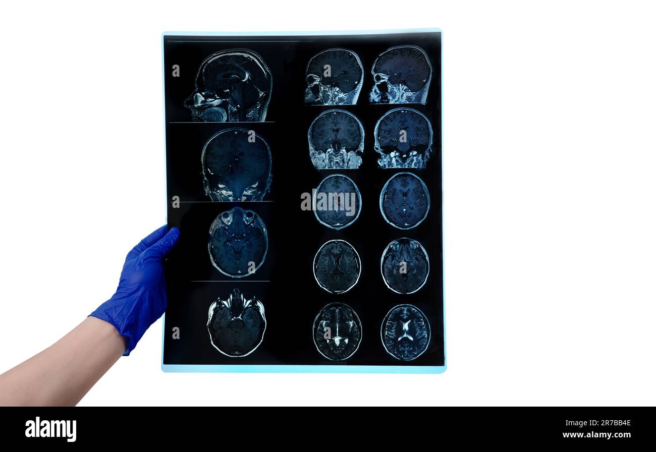 hand in glove holds MRI brain scan or magnetic resonance image results ...