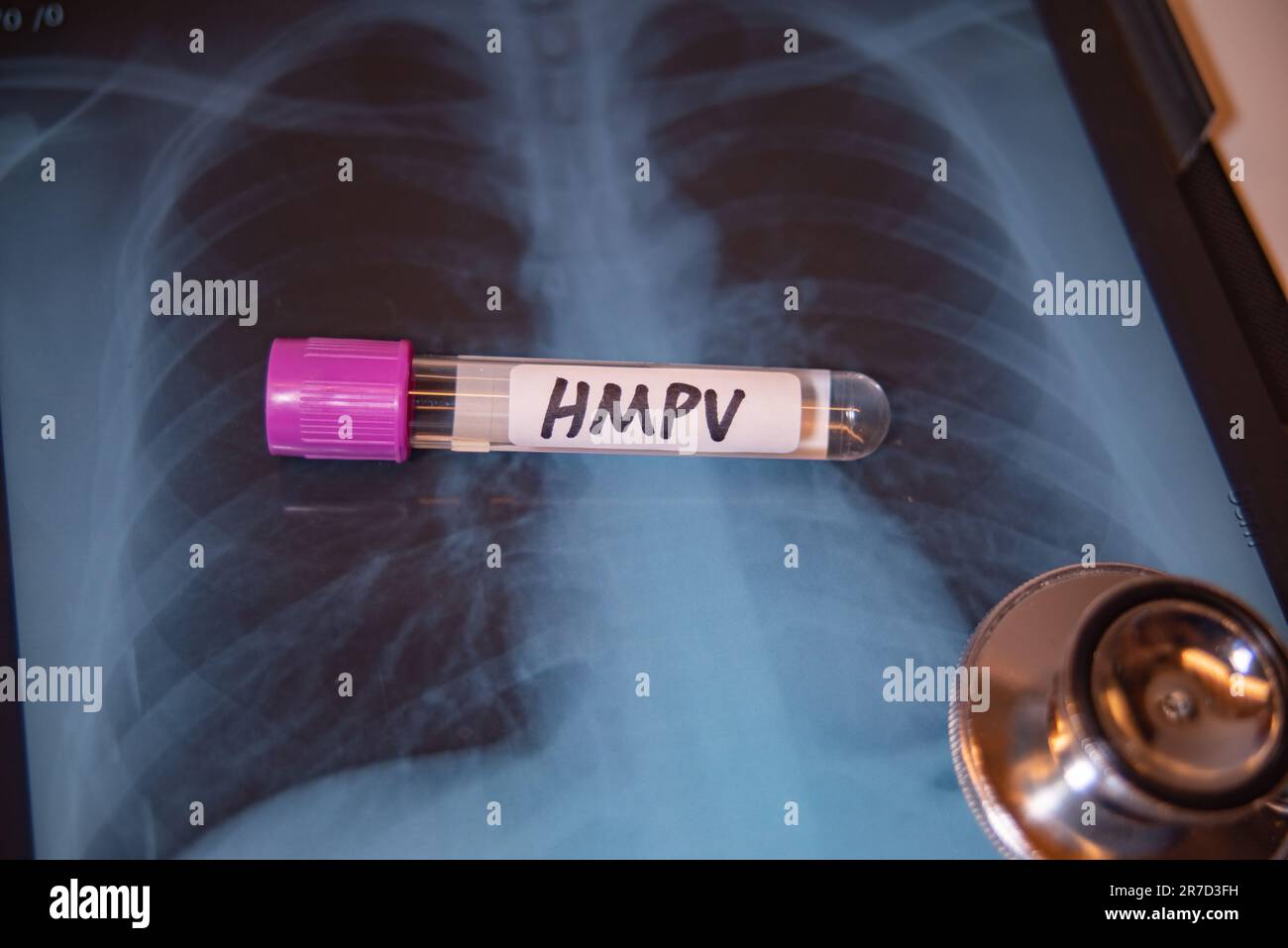 Background of Human Metapneumovirus (HMPV) RT-PCR Kit ,Medical health ...