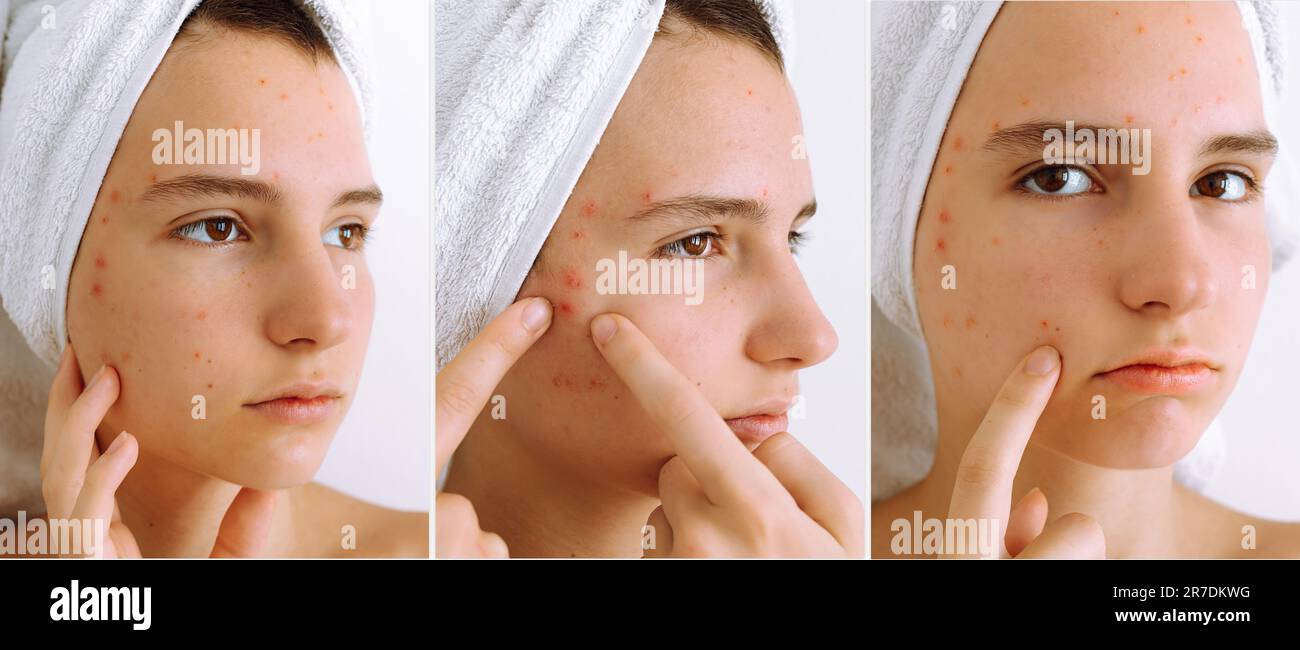 Portrait young teenage girl with problem skin Stock Photo - Alamy