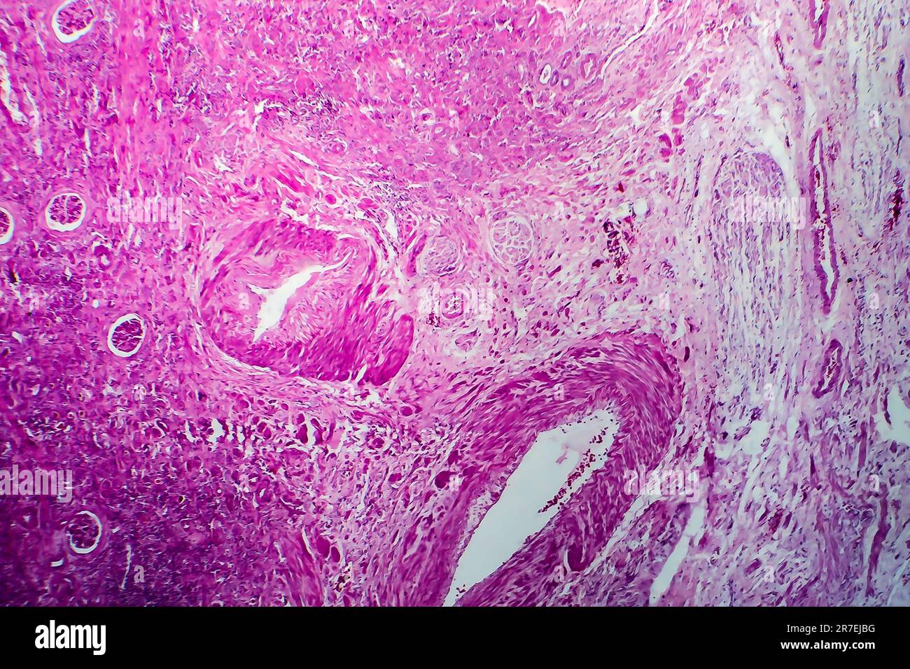 Glomerulonephritis. Light micrograph of tissue from a kidney in a case ...
