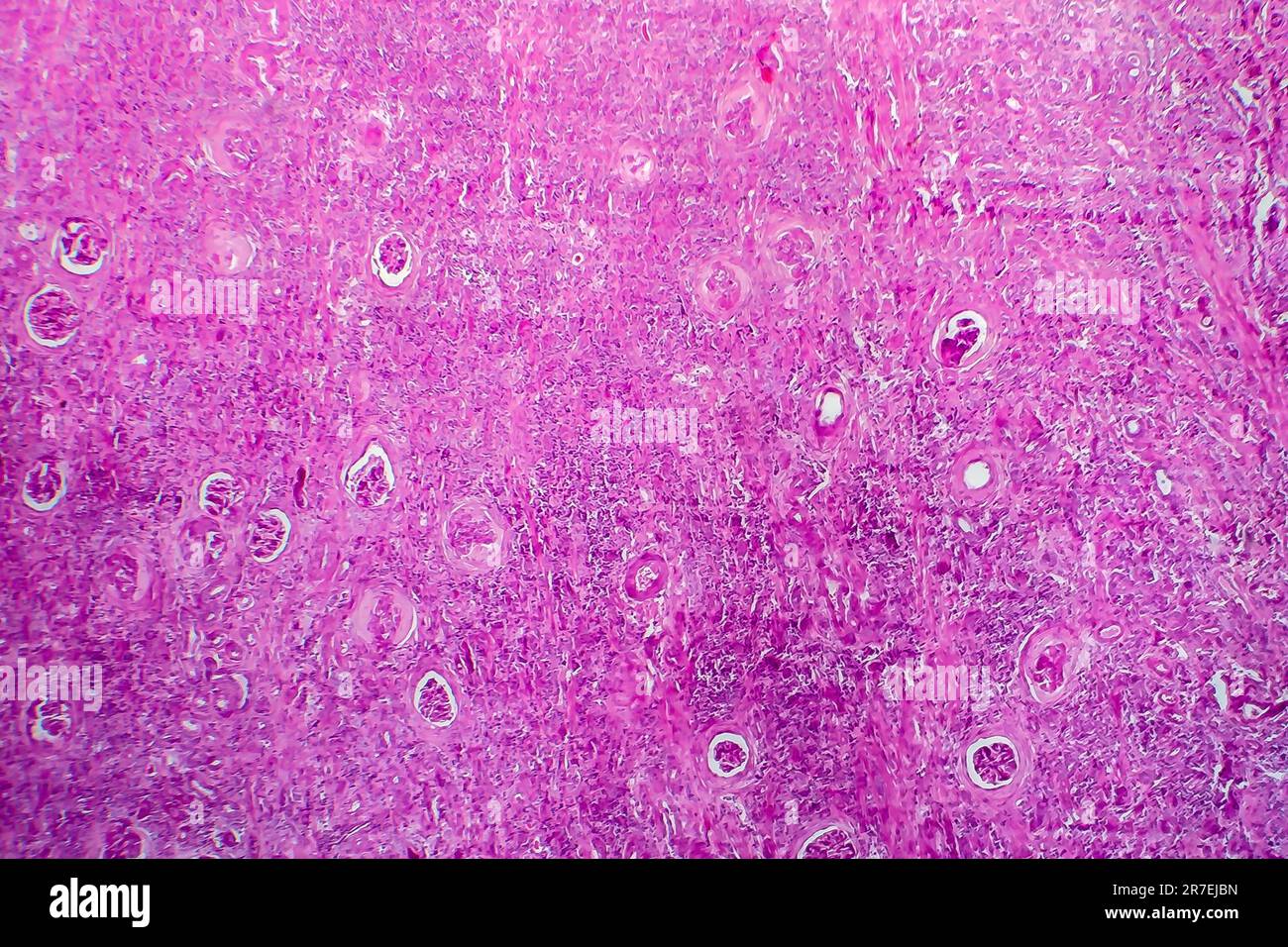 Glomerulonephritis. Light micrograph of tissue from a kidney in a case ...