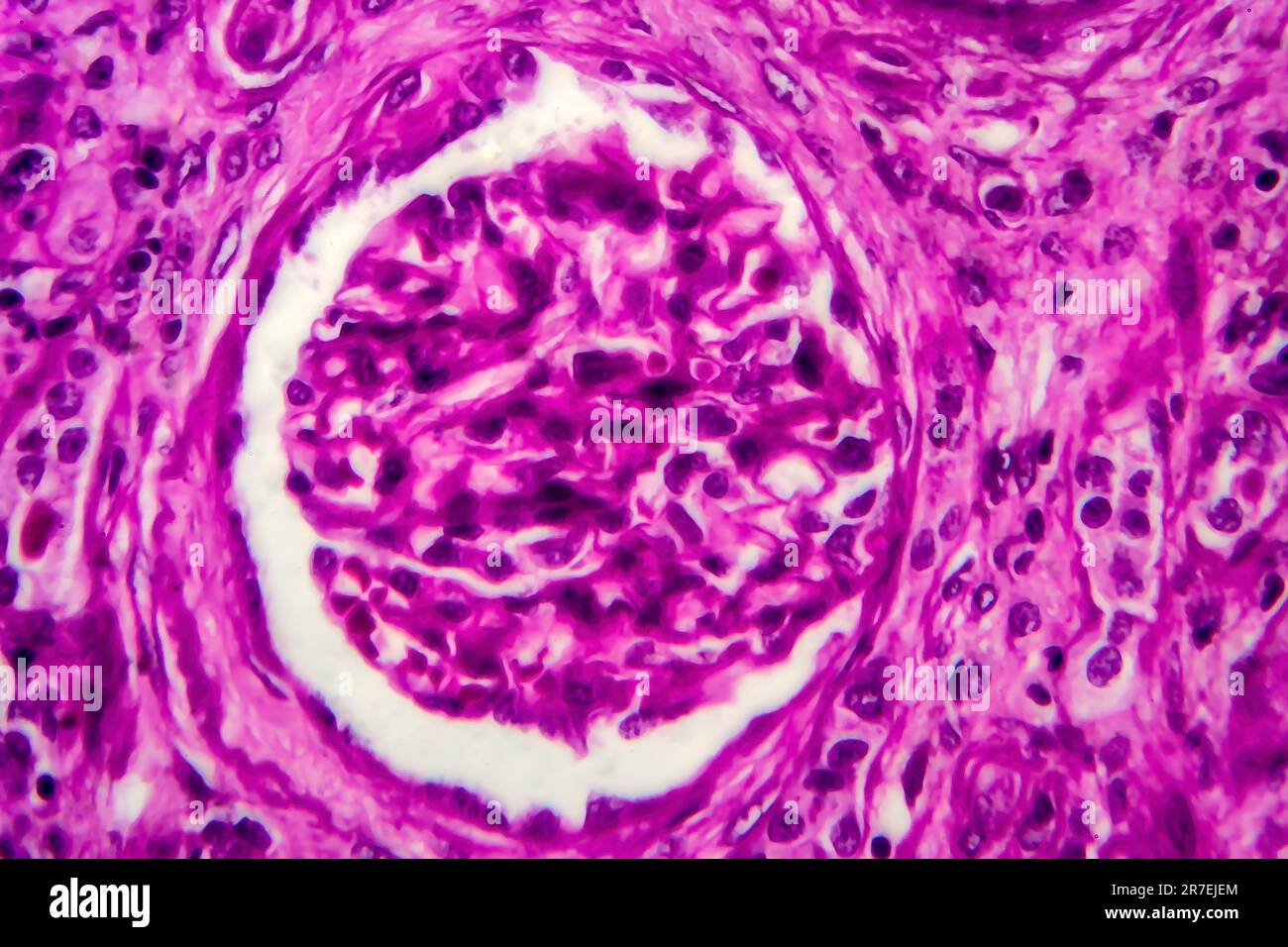 Glomerulonephritis. Light micrograph of tissue from a kidney in a case ...
