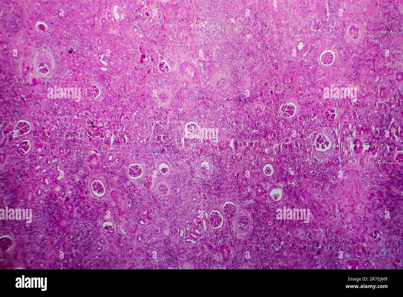 Glomerulonephritis. Light micrograph of tissue from a kidney in a case ...