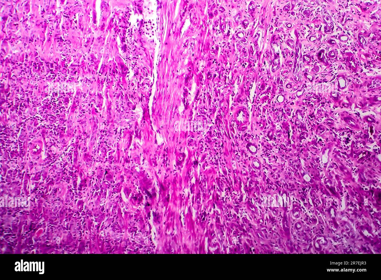 Glomerulonephritis. Light micrograph of tissue from a kidney in a case ...