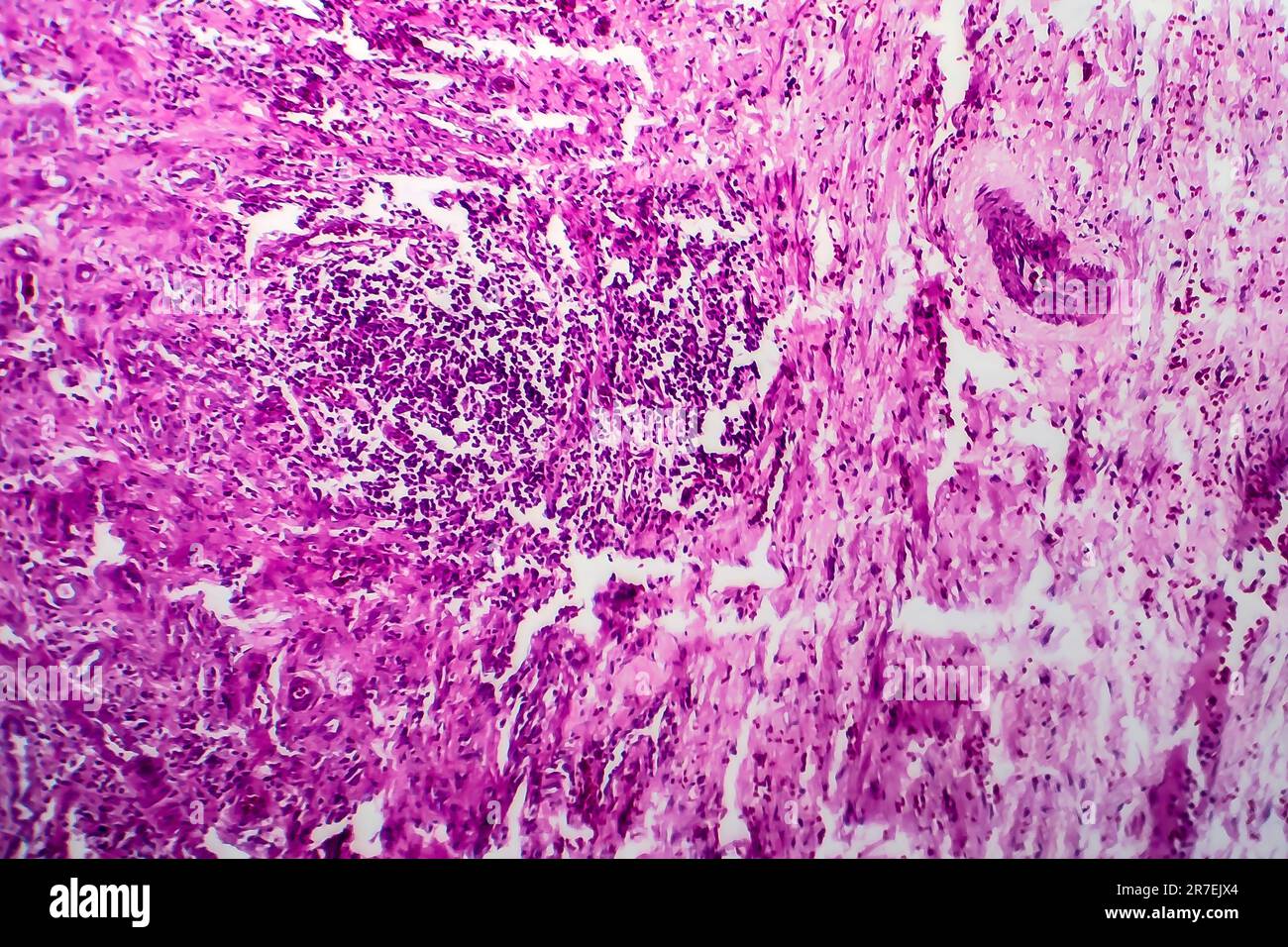 Glomerulonephritis. Light micrograph of tissue from a kidney in a case ...