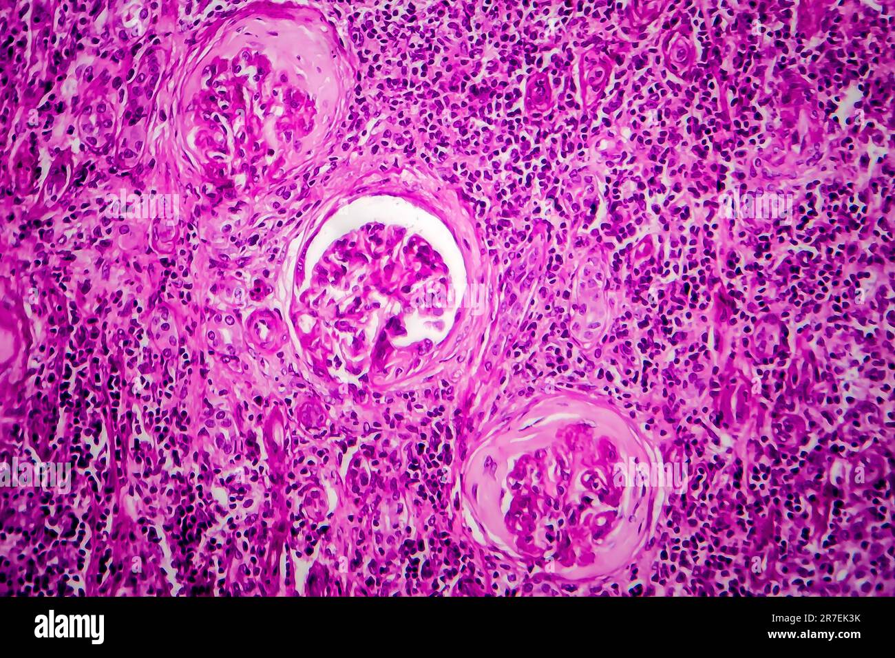 Glomerulonephritis. Light micrograph of tissue from a kidney in a case ...