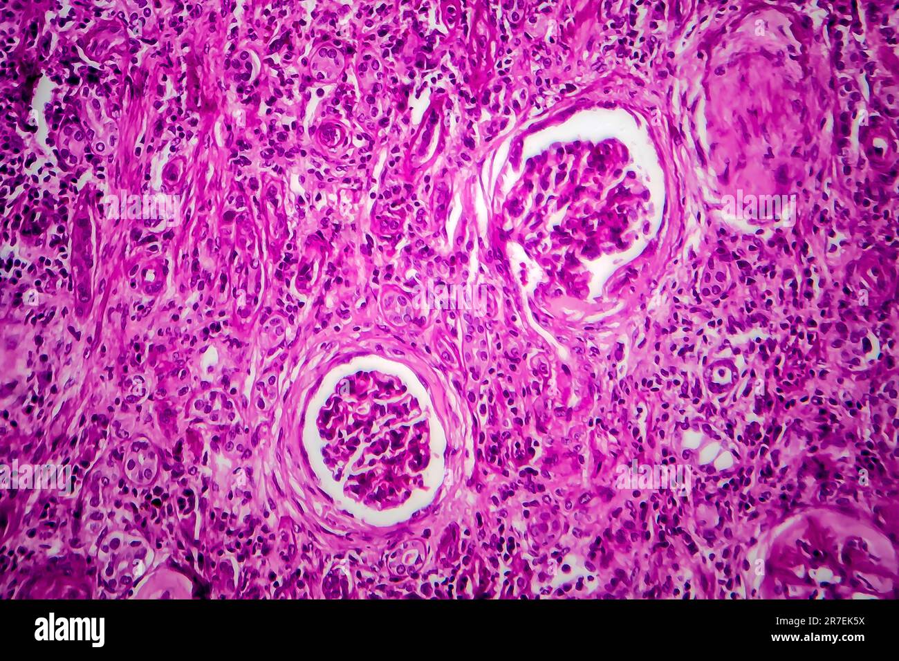 Glomerulonephritis. Light micrograph of tissue from a kidney in a case ...