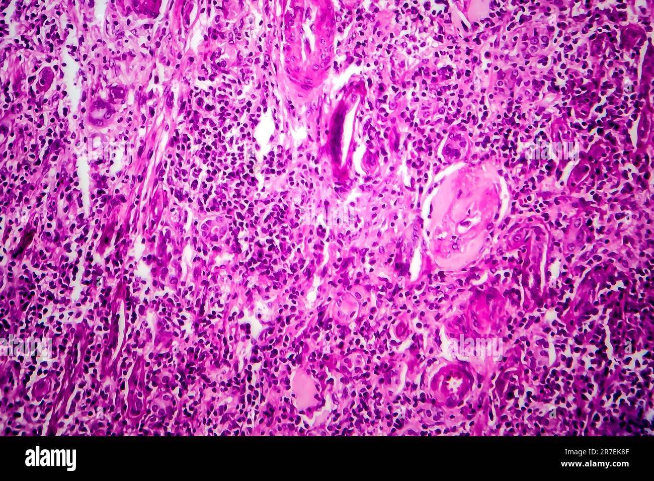 Glomerulonephritis. Light micrograph of tissue from a kidney in a case ...