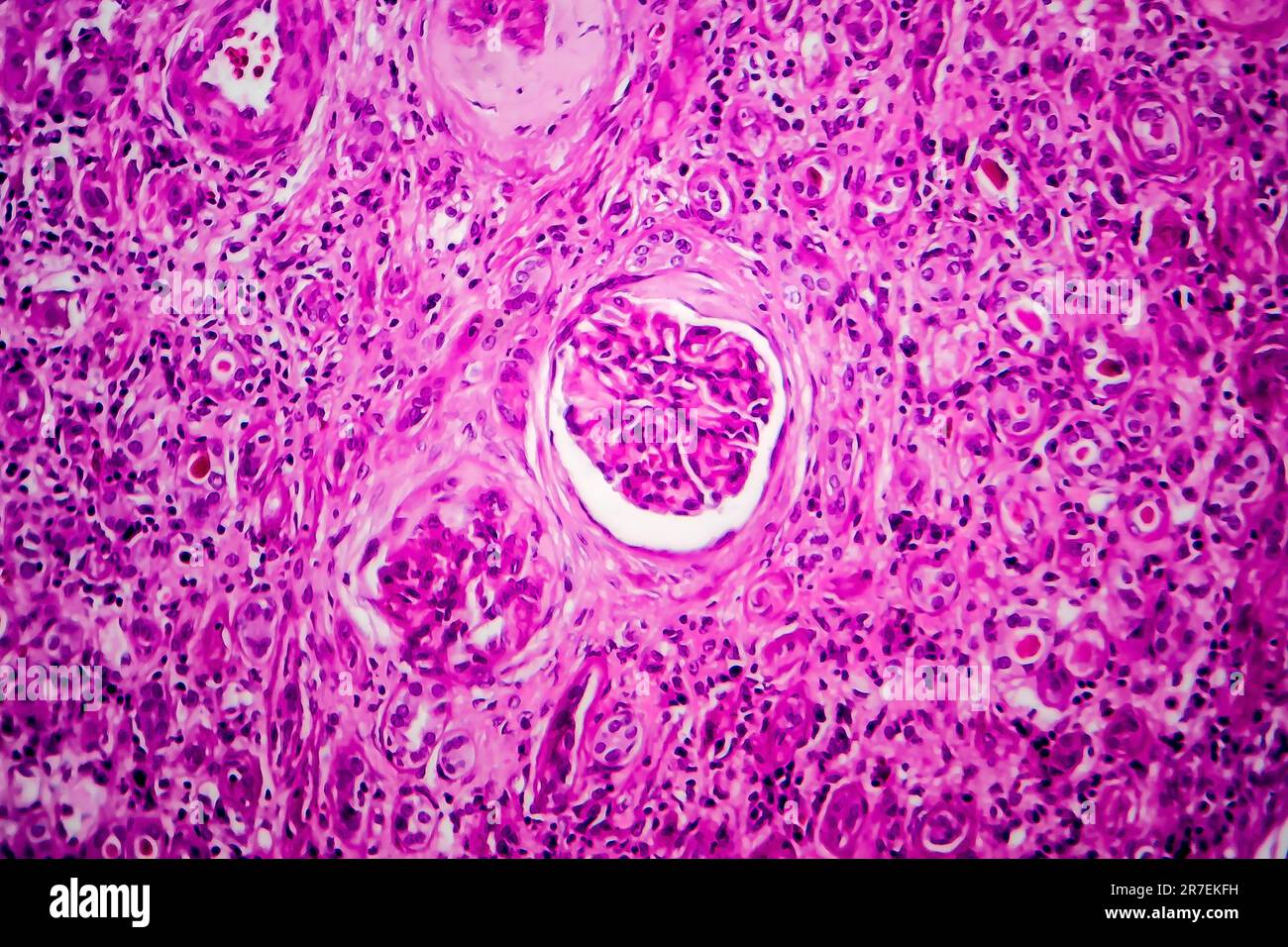 Glomerulonephritis. Light micrograph of tissue from a kidney in a case ...