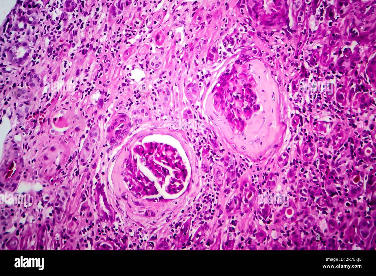 Glomerulonephritis. Light micrograph of tissue from a kidney in a case ...