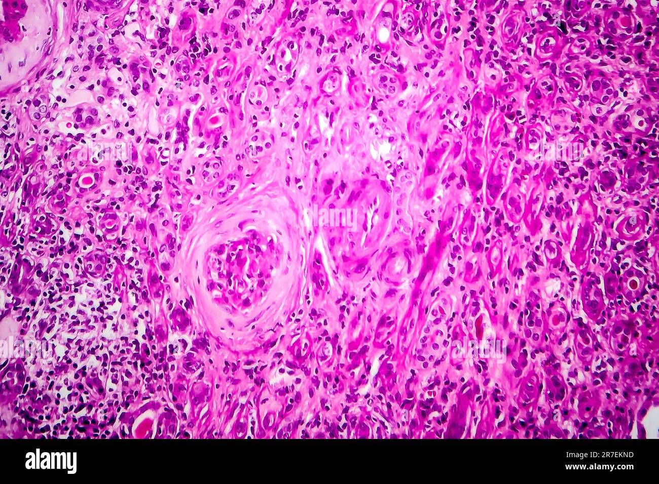 Glomerulonephritis. Light micrograph of tissue from a kidney in a case ...