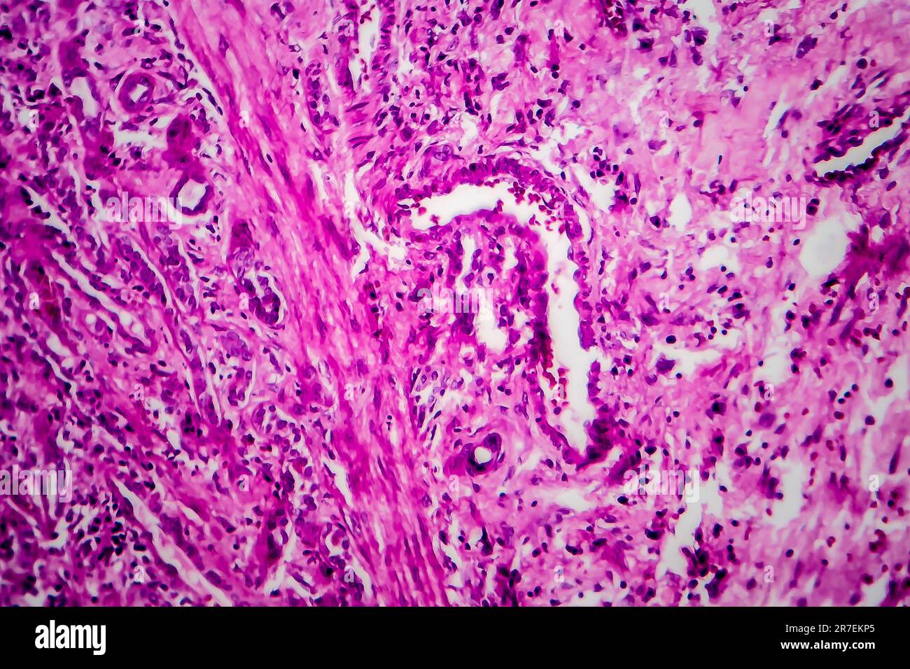 Glomerulonephritis. Light micrograph of tissue from a kidney in a case ...