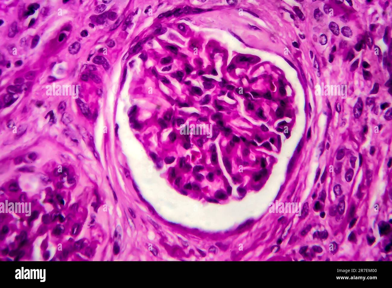 Glomerulonephritis. Light micrograph of tissue from a kidney in a case ...