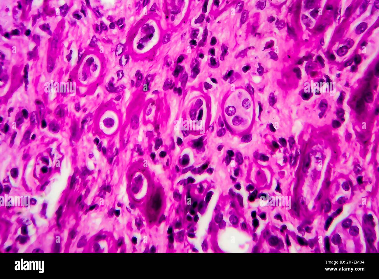 Glomerulonephritis. Light micrograph of tissue from a kidney in a case ...