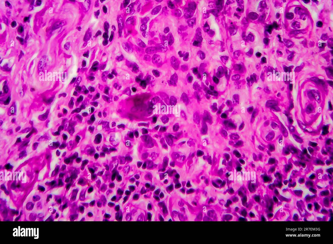 Glomerulonephritis. Light micrograph of tissue from a kidney in a case ...