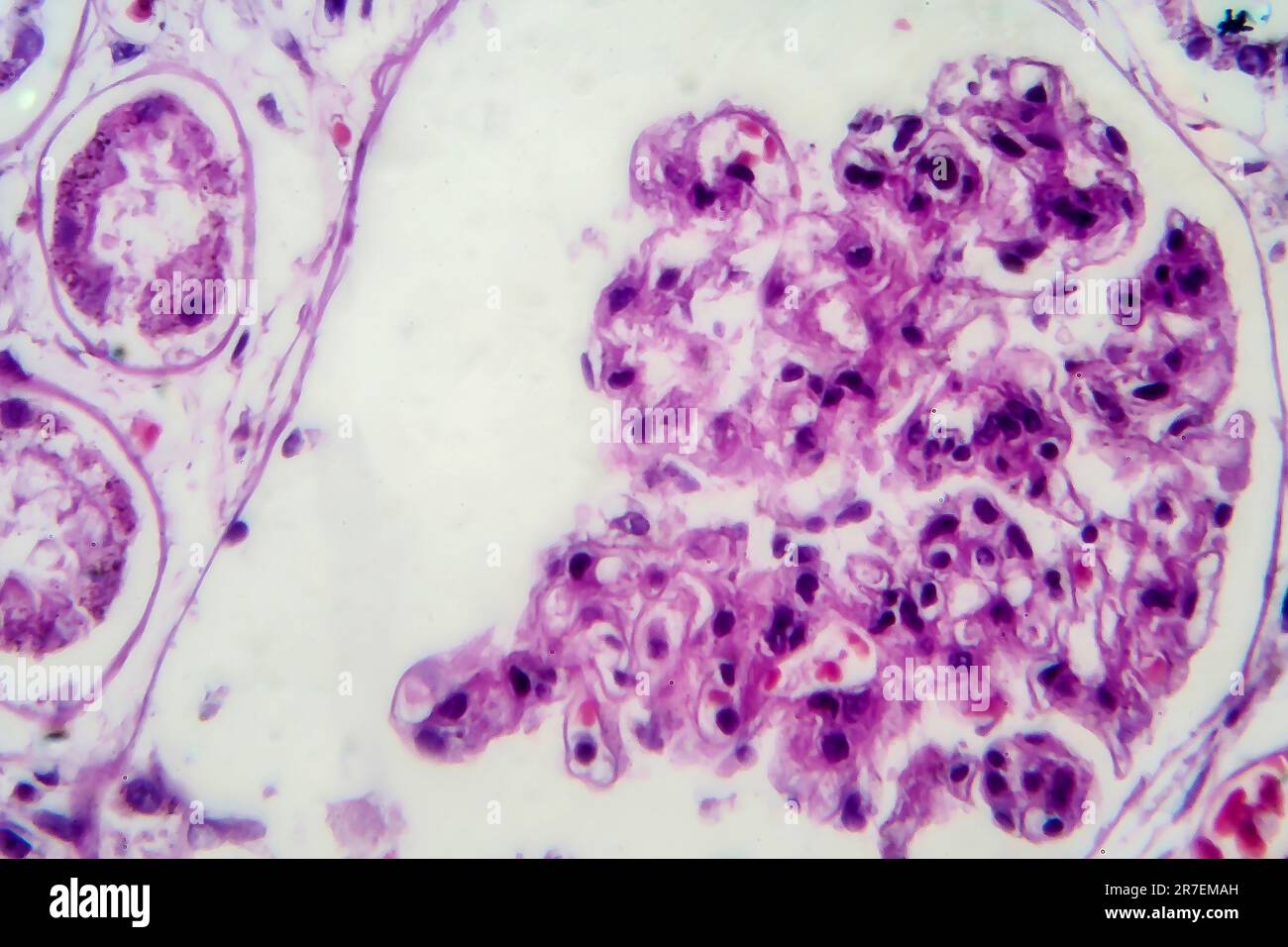 Acute glomerulonephritis hi-res stock photography and images - Alamy