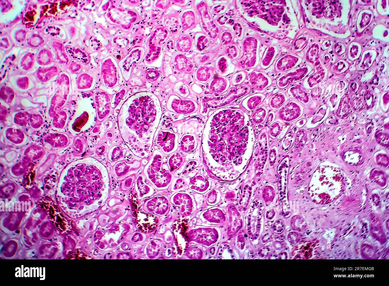 Acute glomerulonephritis hi-res stock photography and images - Alamy