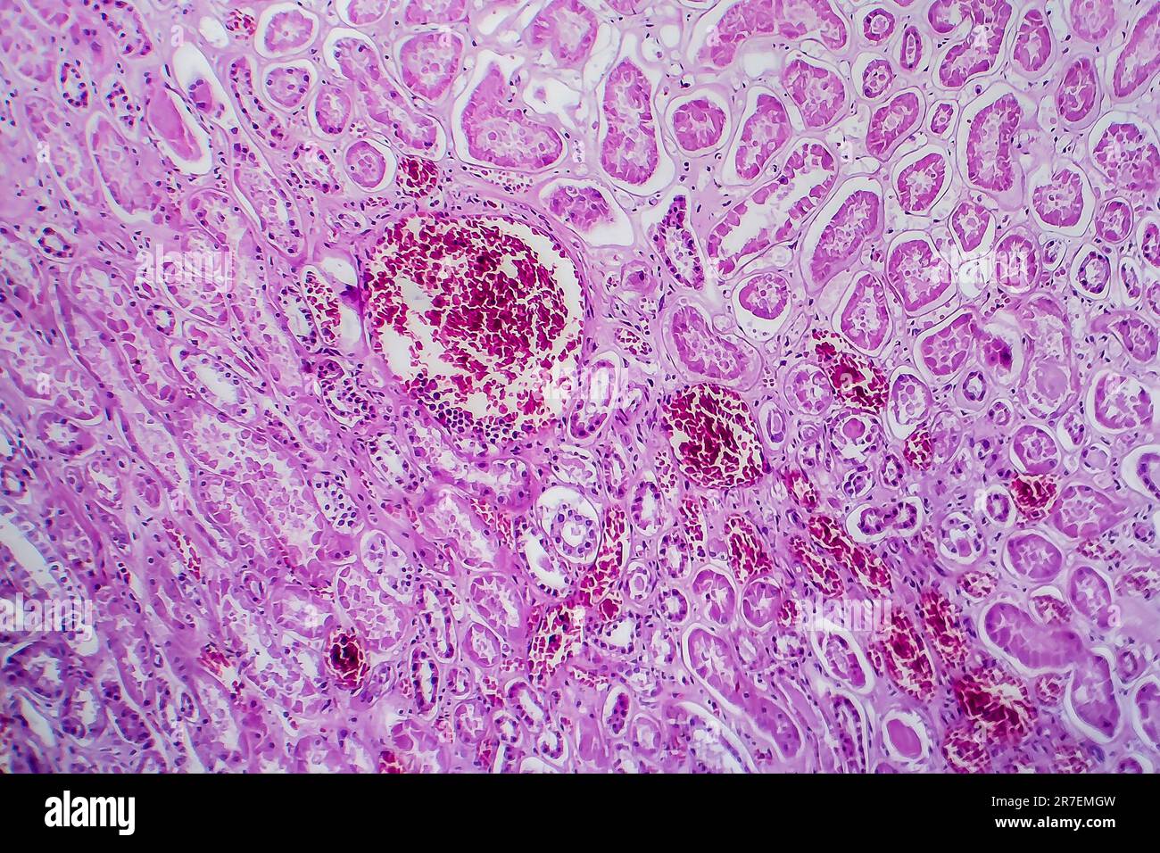Acute glomerulonephritis hi-res stock photography and images - Alamy