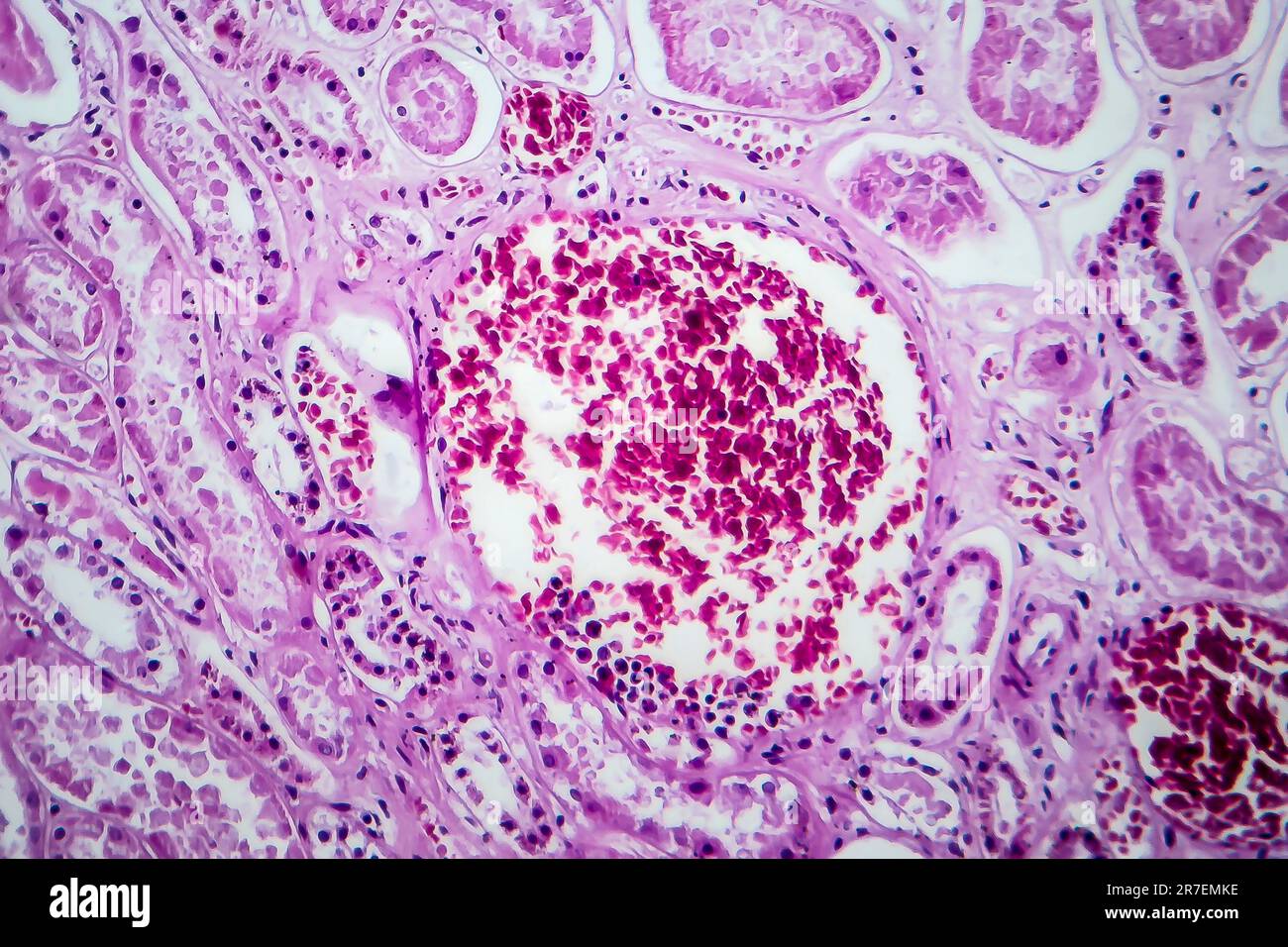 Acute glomerulonephritis hi-res stock photography and images - Alamy