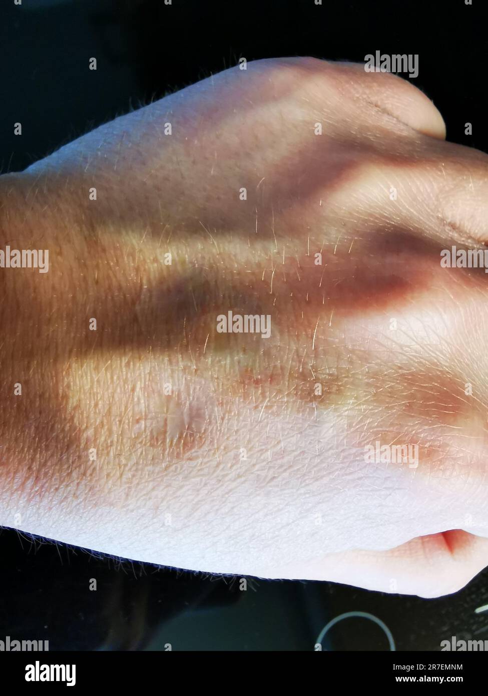 A closeup shot of 3 round second degree marks on the upper hand Stock ...