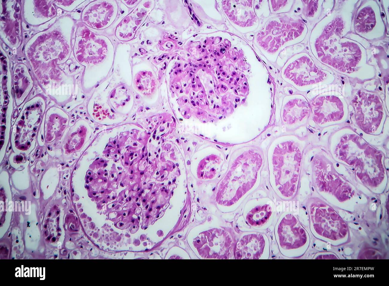 Acute glomerulonephritis hi-res stock photography and images - Alamy