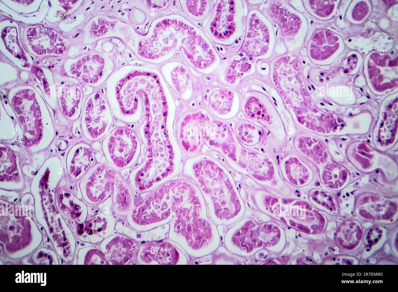 Acute glomerulonephritis hi-res stock photography and images - Alamy