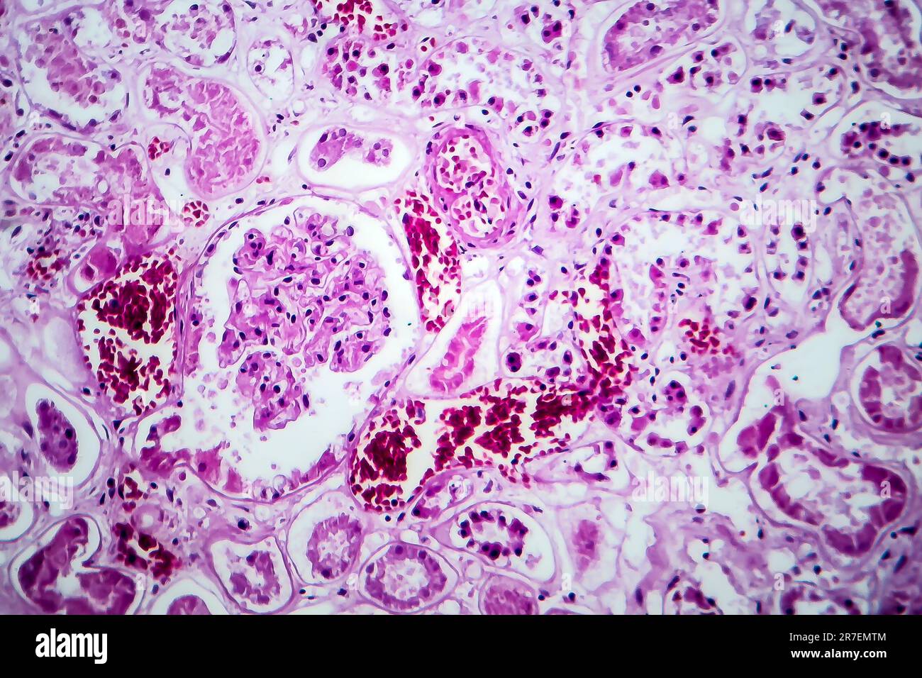 Acute glomerulonephritis hi-res stock photography and images - Alamy