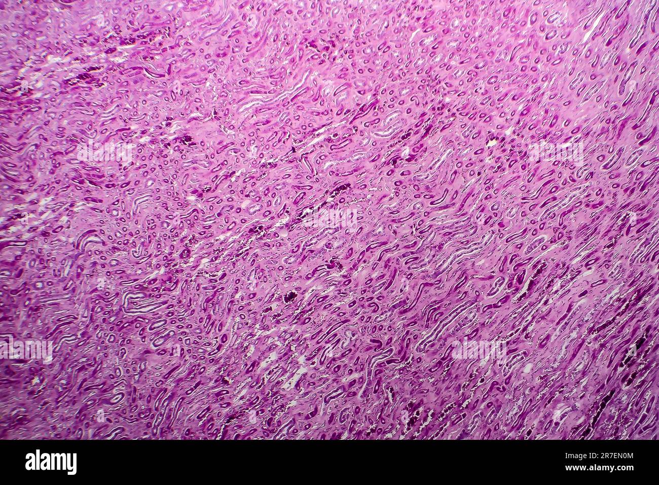 Glomerulonephritis. Light micrograph of tissue from a kidney in a case ...
