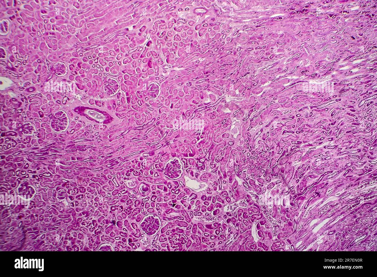 Glomerulonephritis. Light micrograph of tissue from a kidney in a case ...