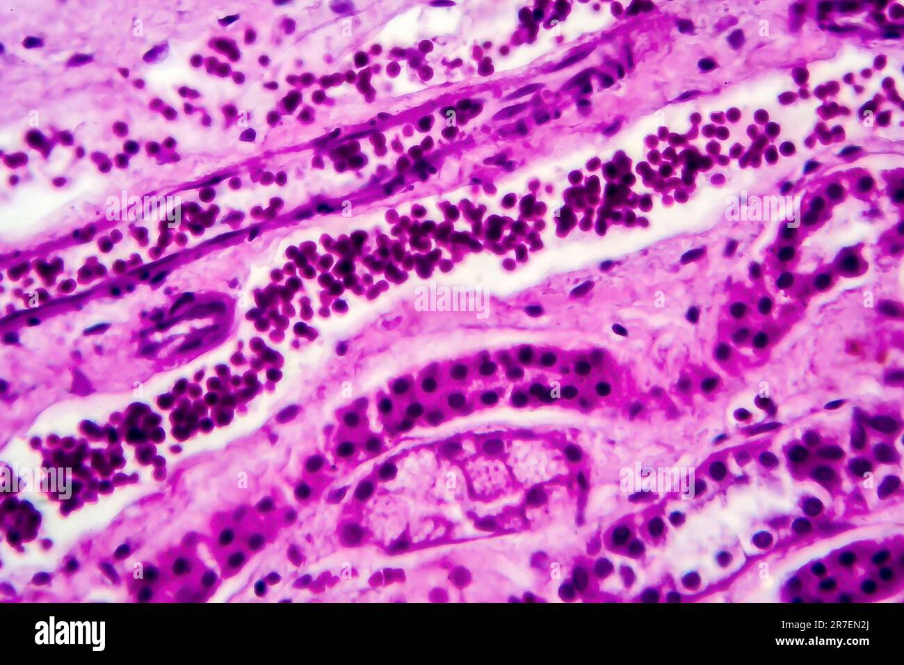Glomerulonephritis. Light micrograph of tissue from a kidney in a case ...