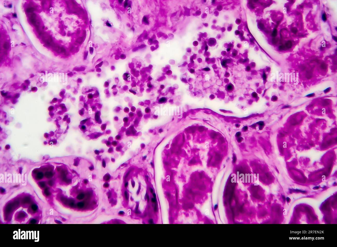 Glomerulonephritis. Light micrograph of tissue from a kidney in a case ...