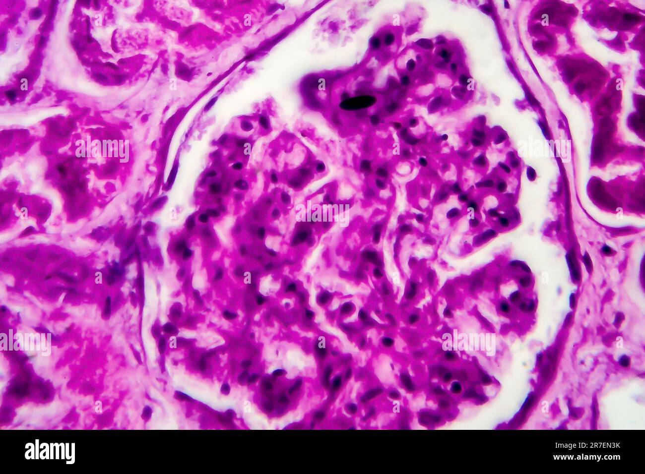 Glomerulonephritis. Light micrograph of tissue from a kidney in a case ...