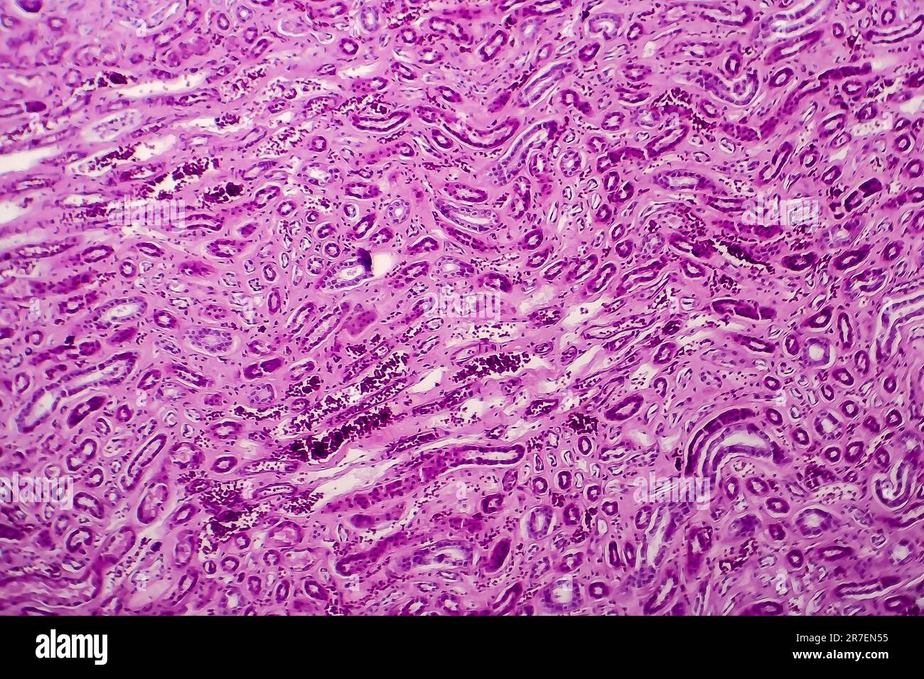 Glomerulonephritis. Light micrograph of tissue from a kidney in a case ...