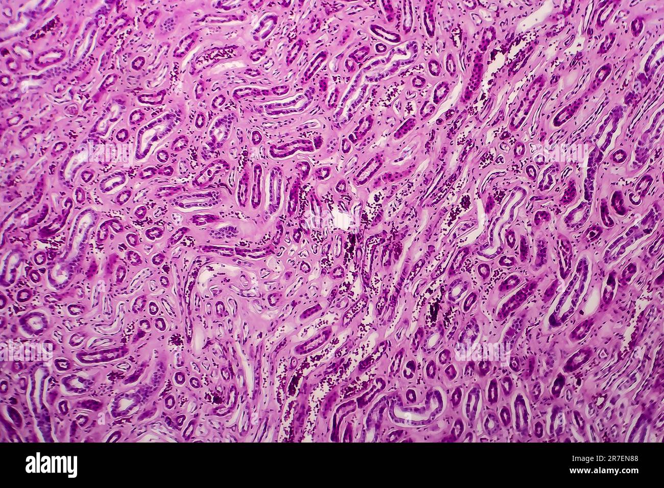Glomerulonephritis. Light micrograph of tissue from a kidney in a case ...