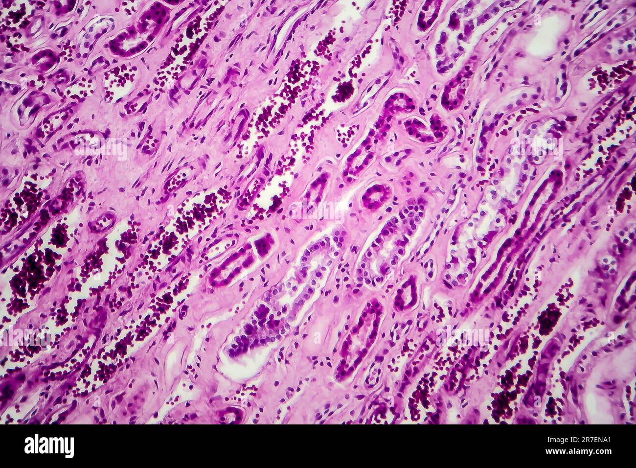 Glomerulonephritis. Light micrograph of tissue from a kidney in a case ...