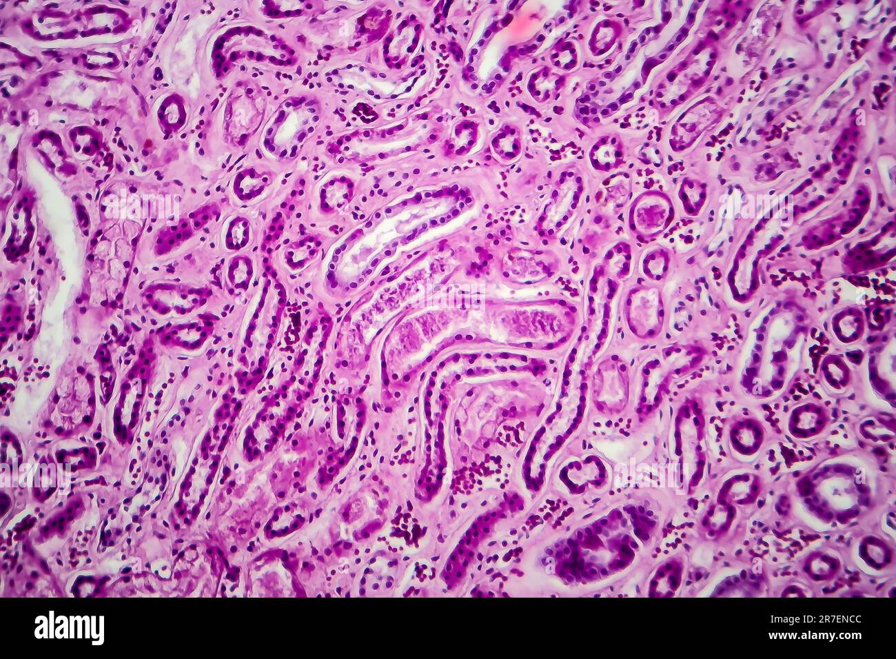 Glomerulonephritis. Light micrograph of tissue from a kidney in a case ...
