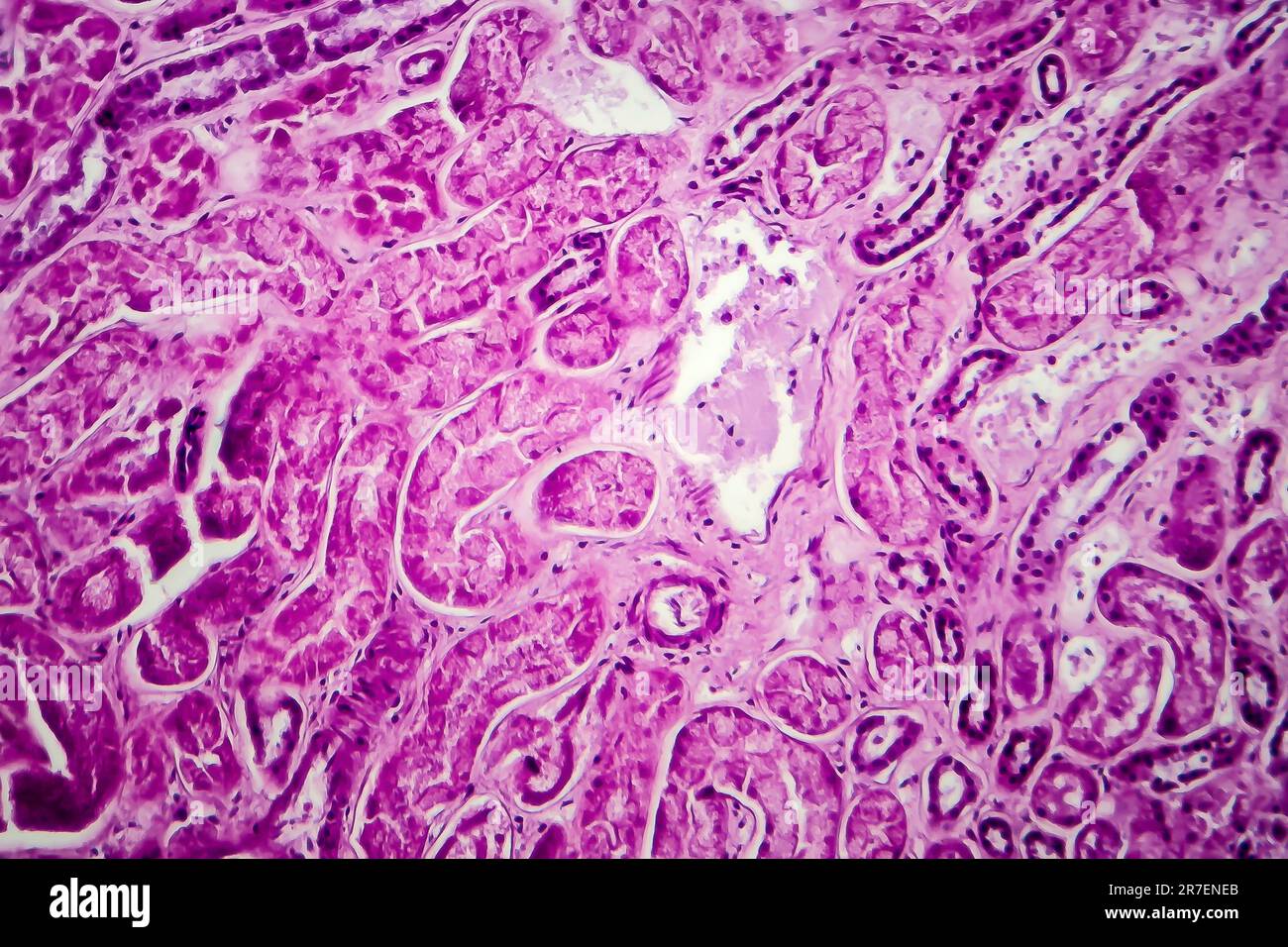 Glomerulonephritis. Light micrograph of tissue from a kidney in a case ...