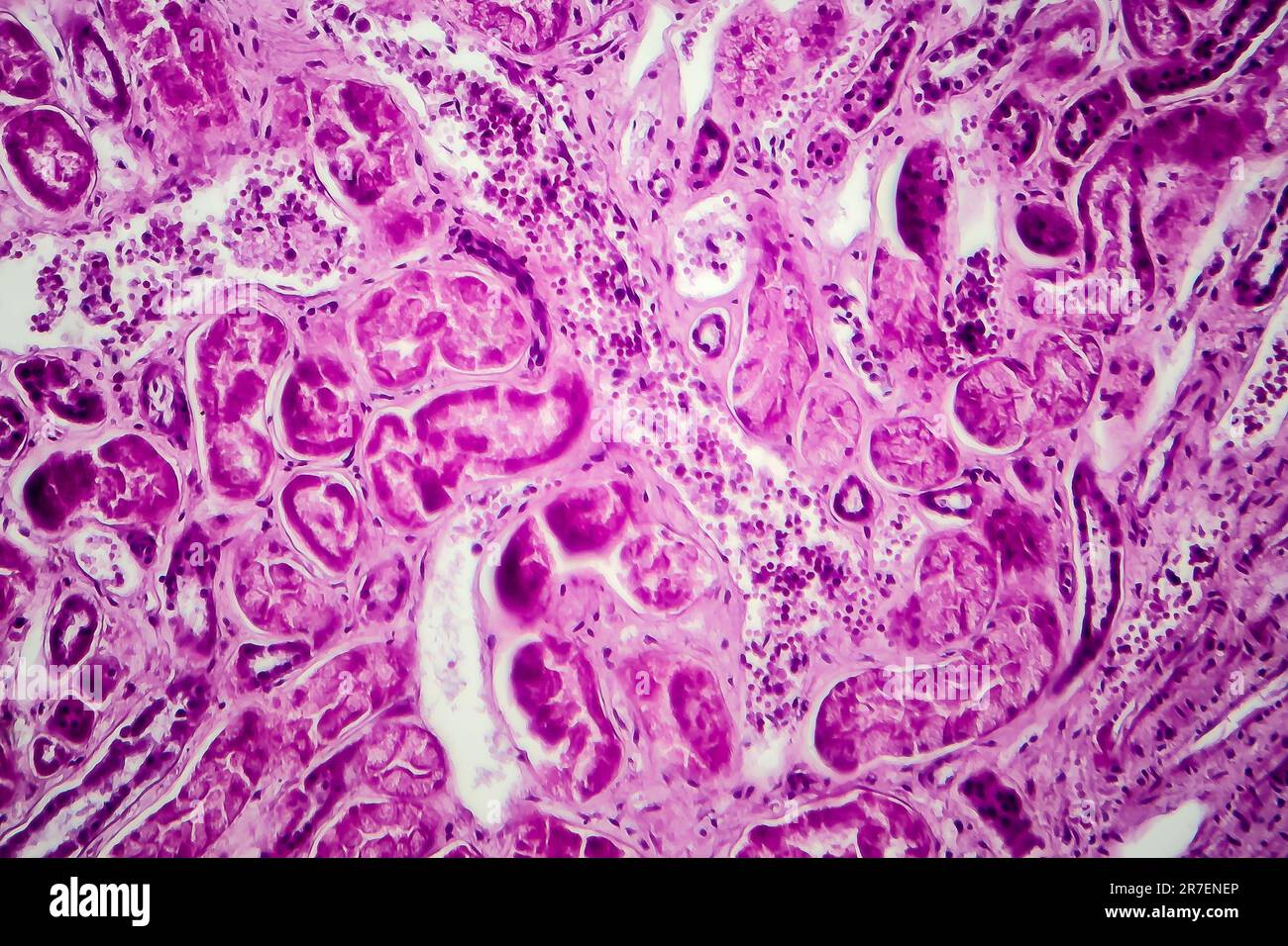 Glomerulonephritis. Light micrograph of tissue from a kidney in a case ...