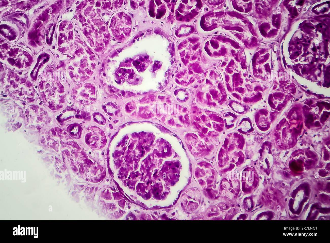 Glomerulonephritis. Light micrograph of tissue from a kidney in a case ...