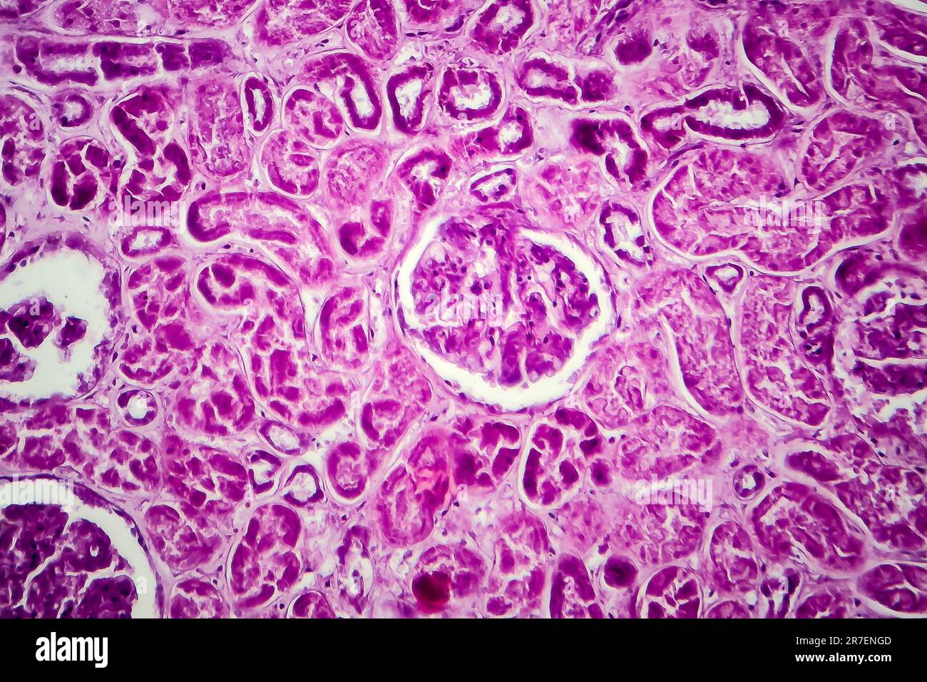 Glomerulonephritis. Light micrograph of tissue from a kidney in a case ...