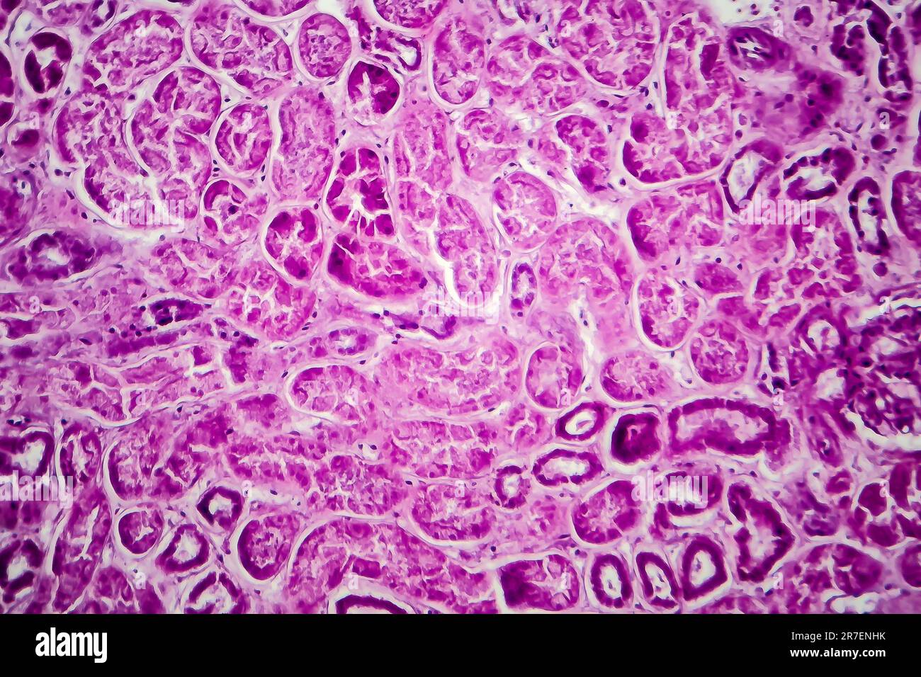 Glomerulonephritis. Light micrograph of tissue from a kidney in a case ...